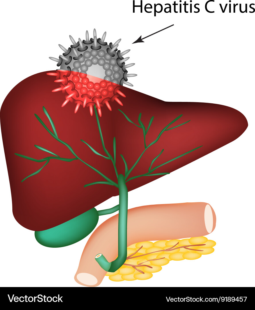 Hepatitis c the introduction Royalty Free Vector Image