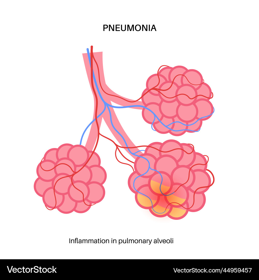 Pneumonia infection concept Royalty Free Vector Image