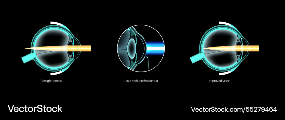 Lasik farsightedness surgery Royalty Free Vector Image