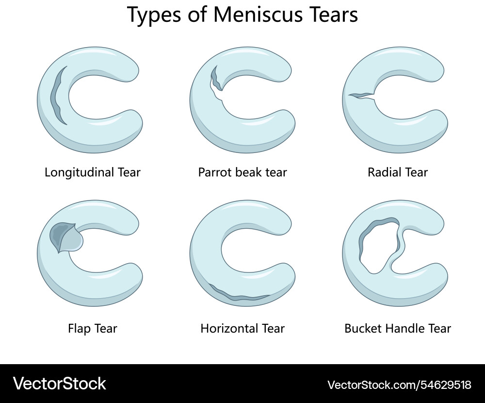 Meniscus tear types diagram medical science Vector Image