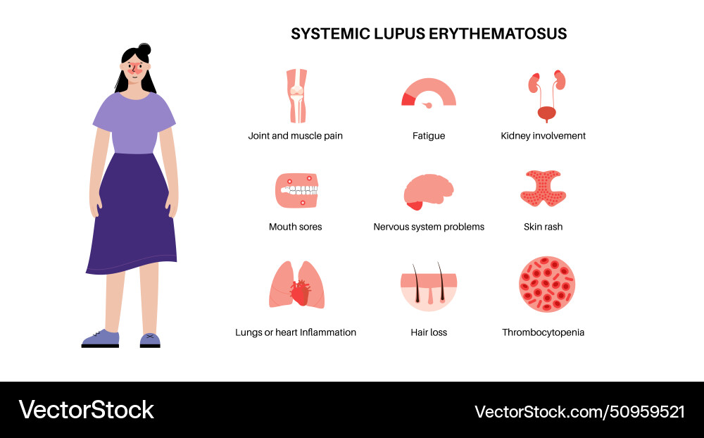 Systemic lupus erythematosus Royalty Free Vector Image