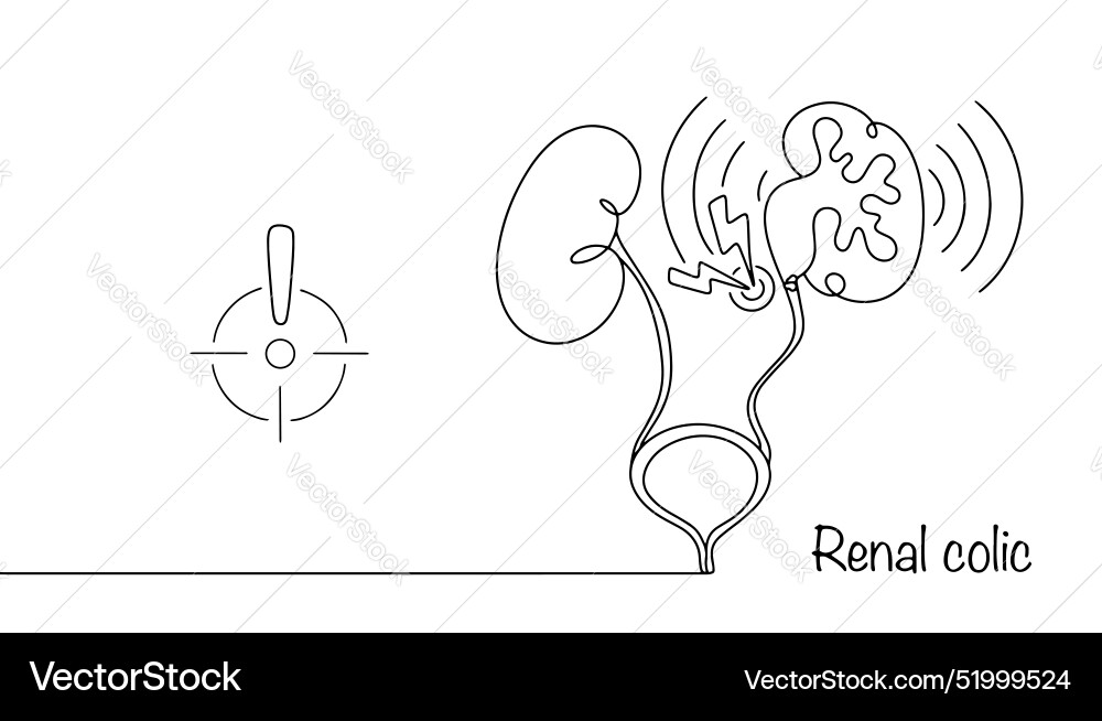 Renal colic Royalty Free Vector Image - VectorStock