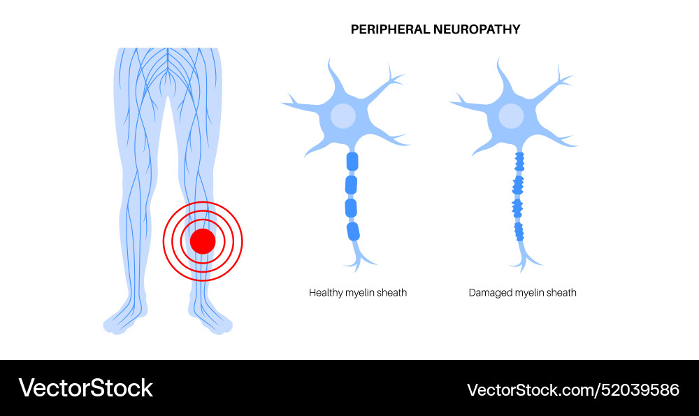 Peripheral neuropathy medical poster Royalty Free Vector