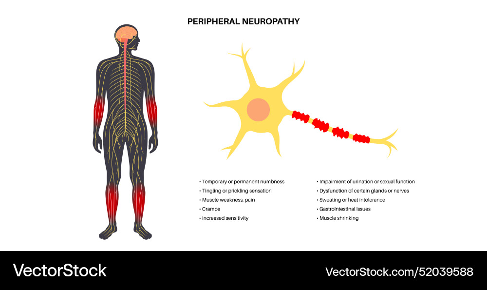 Peripheral neuropathy medical poster Royalty Free Vector