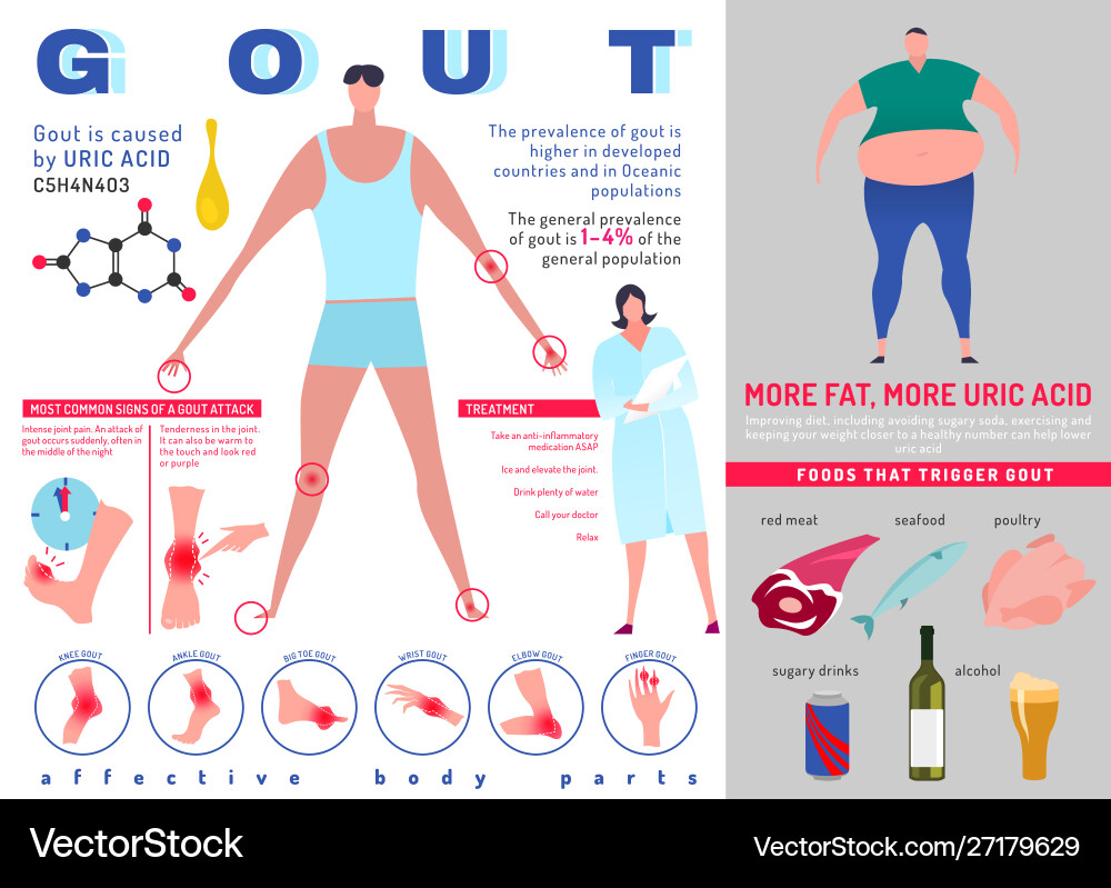Gout arthritis infographic Royalty Free Vector Image