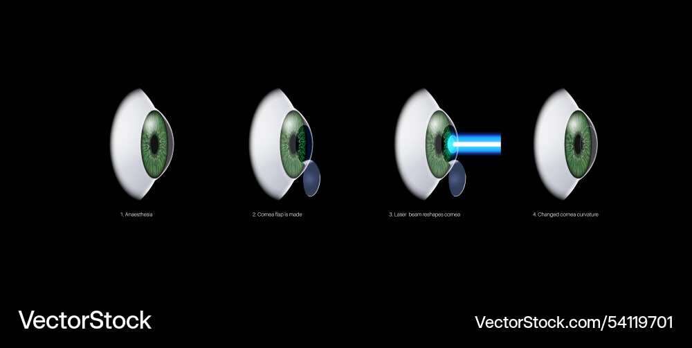 Lasik eye surgery Royalty Free Vector Image - VectorStock