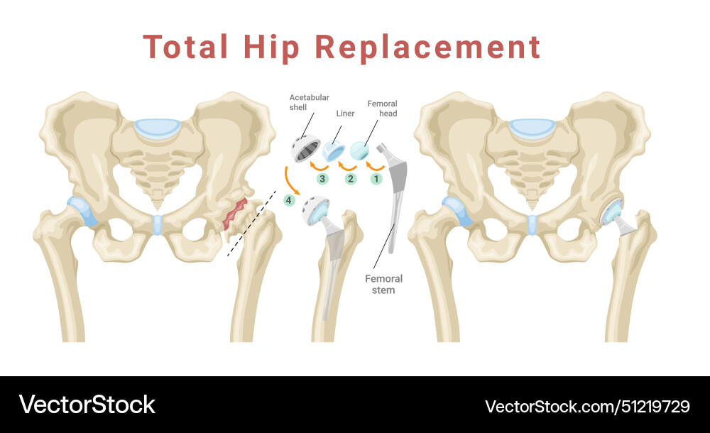 Total hip replacement surgery with anatomical Vector Image
