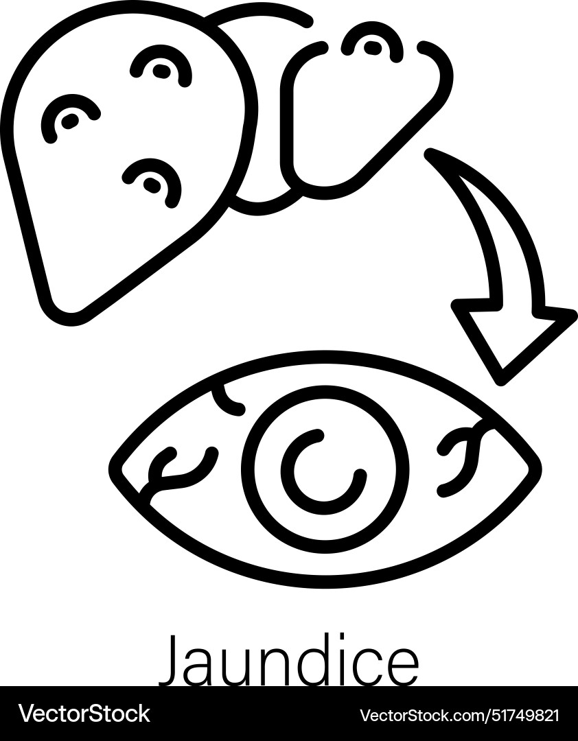 Jaundice Royalty Free Vector Image - VectorStock