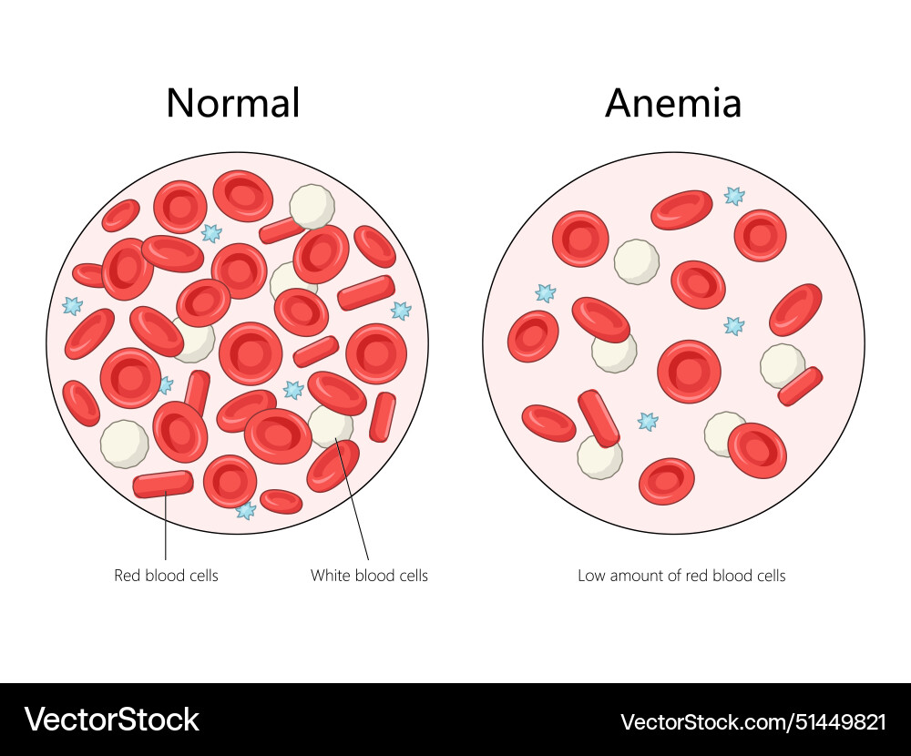 Normal vs anemia blood cell comparison medical Vector Image
