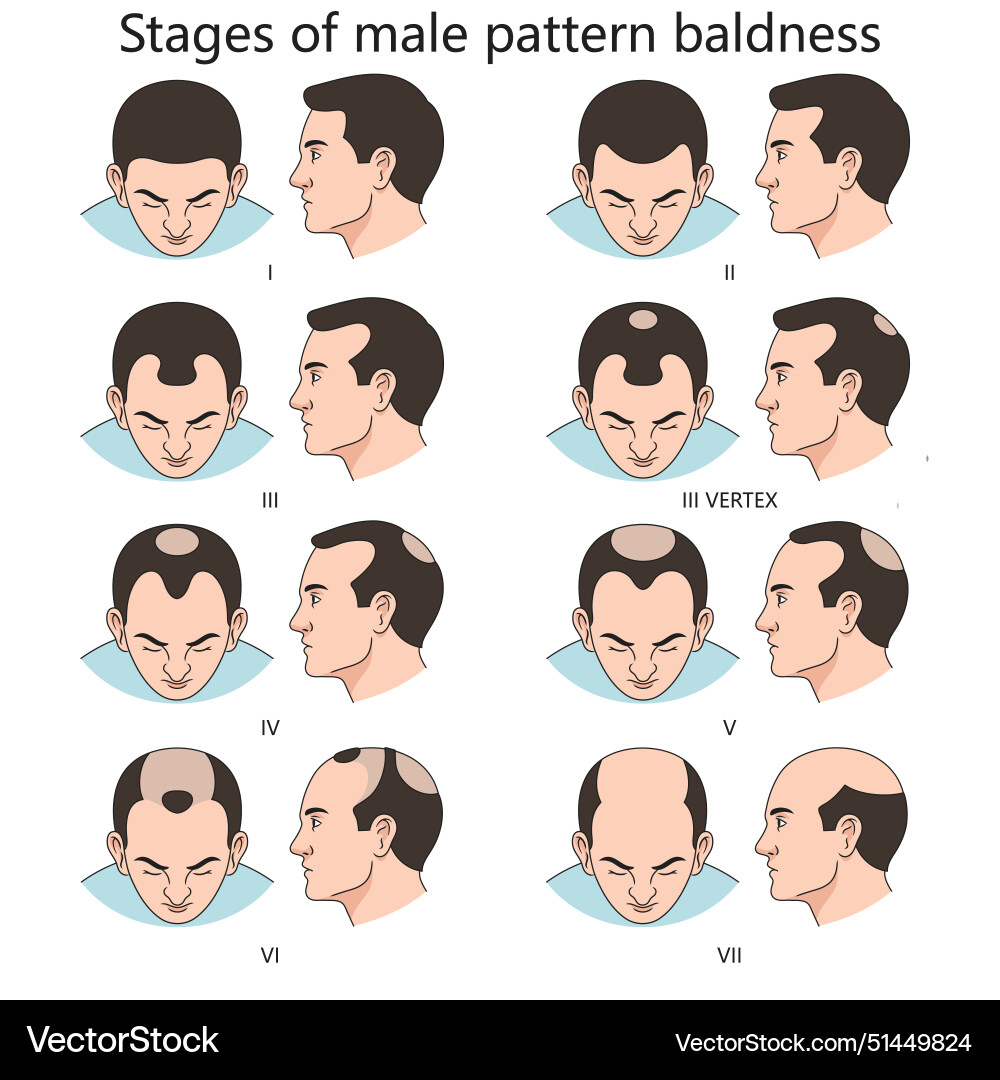 Stages of male pattern baldness diagram medical Vector Image
