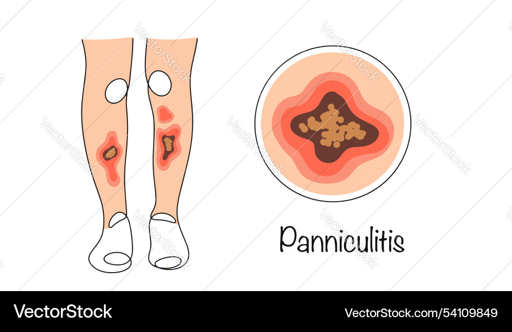 Panniculitis Royalty Free Vector Image - VectorStock