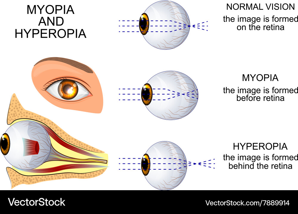 Quotastigmatism Myopia And Hyperopiaquot Imagens E Vetores De Stock Royalty