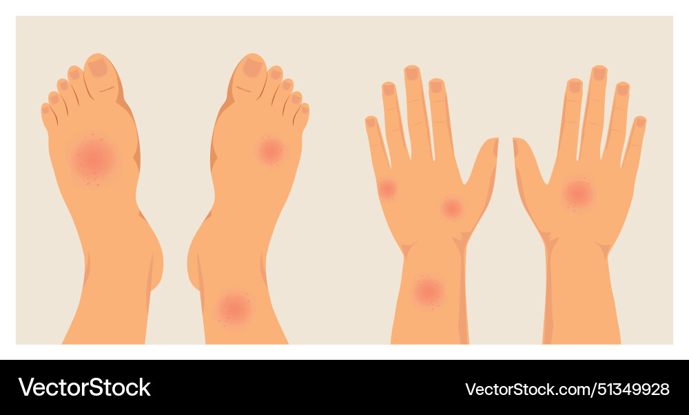 Human legs and hands covered with red rash Vector Image