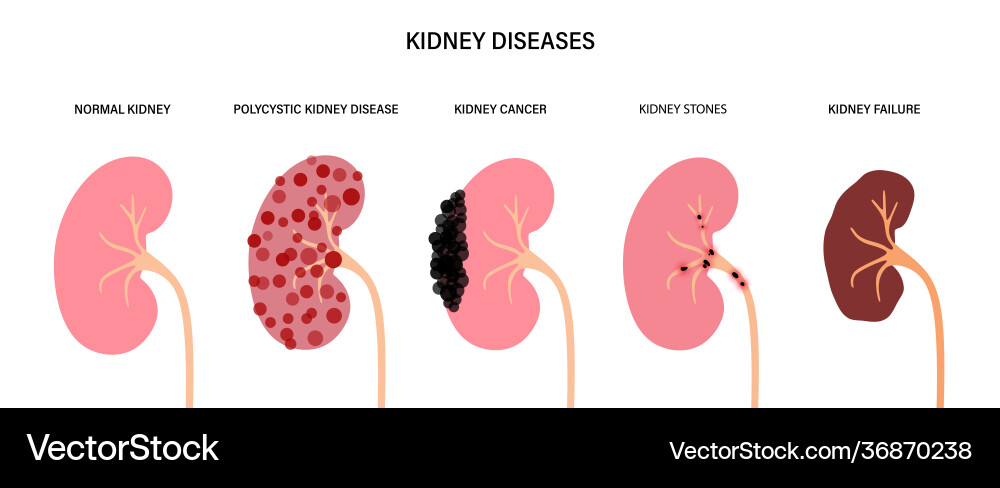 Kidney disease concept Royalty Free Vector Image