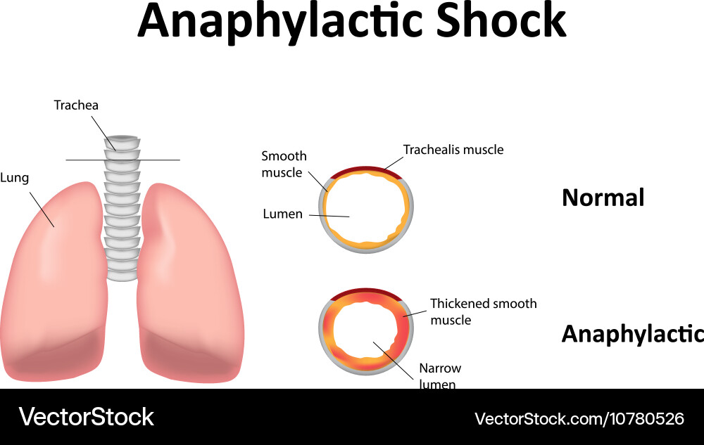 Anaphylactic Shock Lungs Royalty Free Vector Image