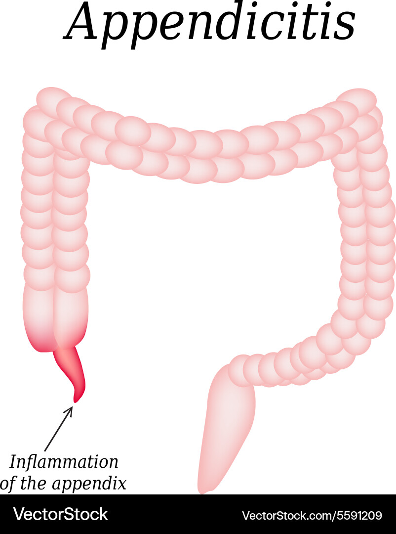 Appendicitis Inflammation of the appendix Colon Vector Image