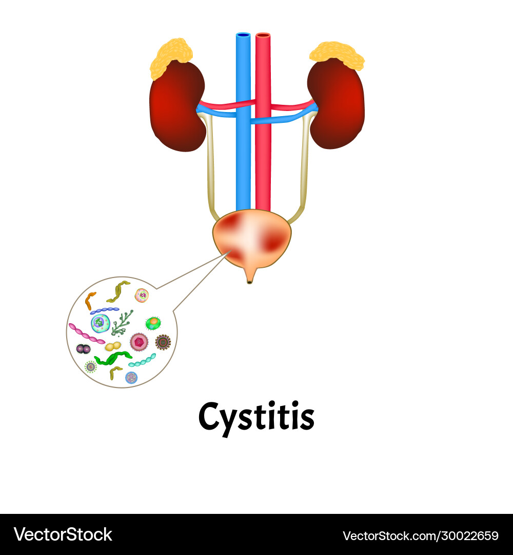 Cystitis inflammation bladder Royalty Free Vector Image