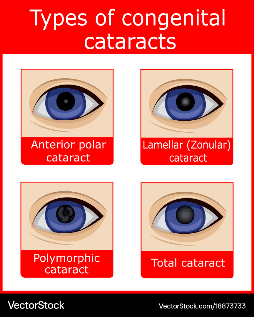 Types of congenital cataracts Royalty Free Vector Image