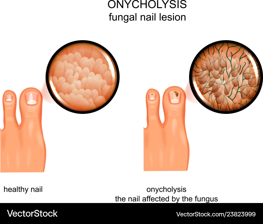 Fungal nail lesion Royalty Free Vector Image - VectorStock