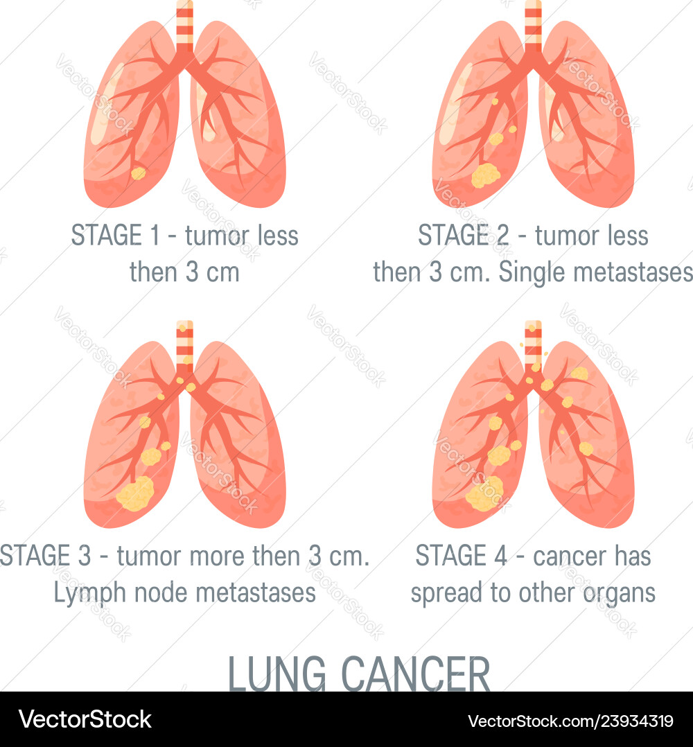 Lung cancer concept in flat style Royalty Free Vector Image