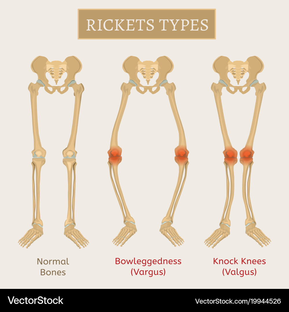 Rickets scheme Royalty Free Vector Image - VectorStock