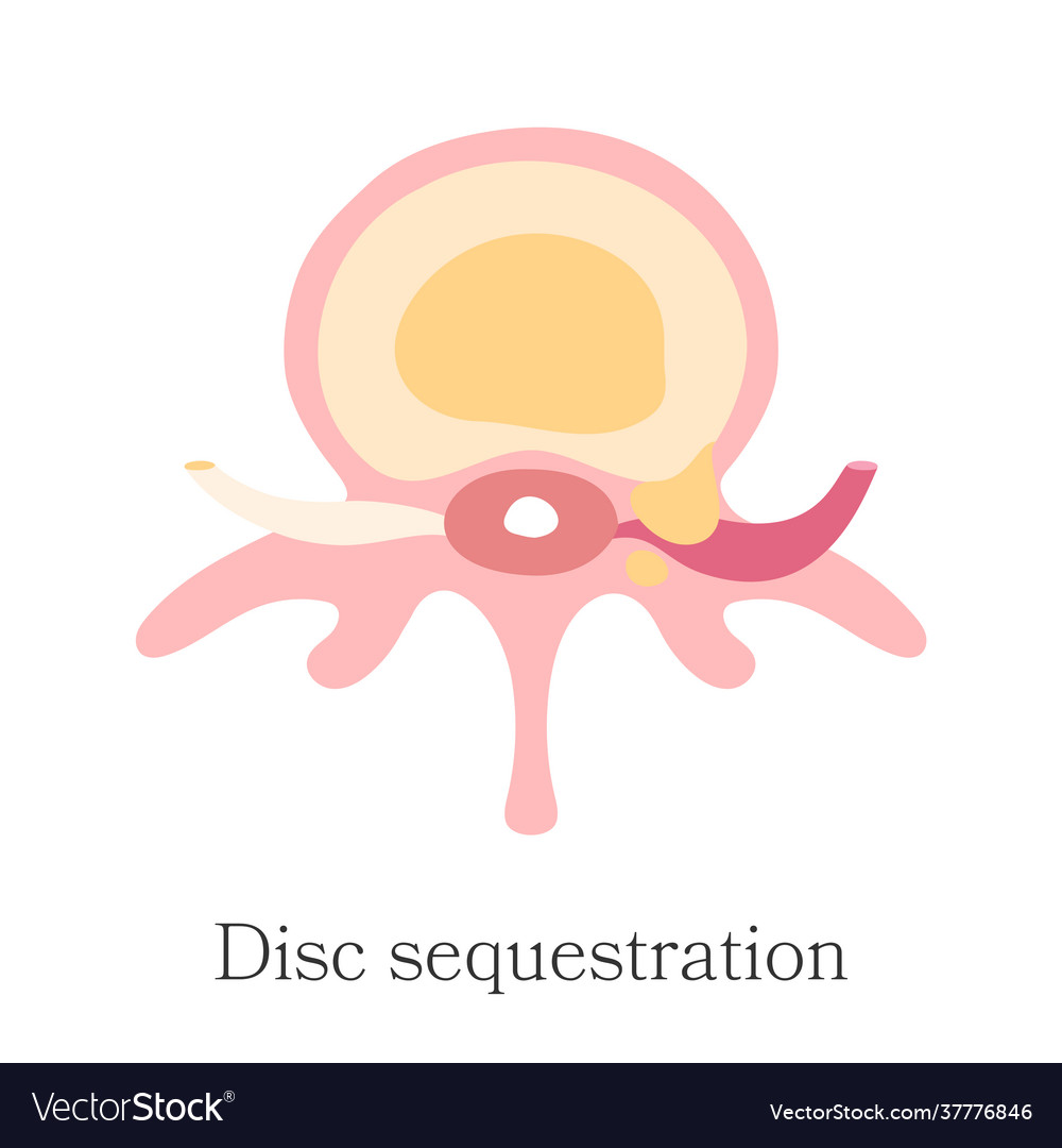 Herniated spinal stage fourth sequestration Vector Image