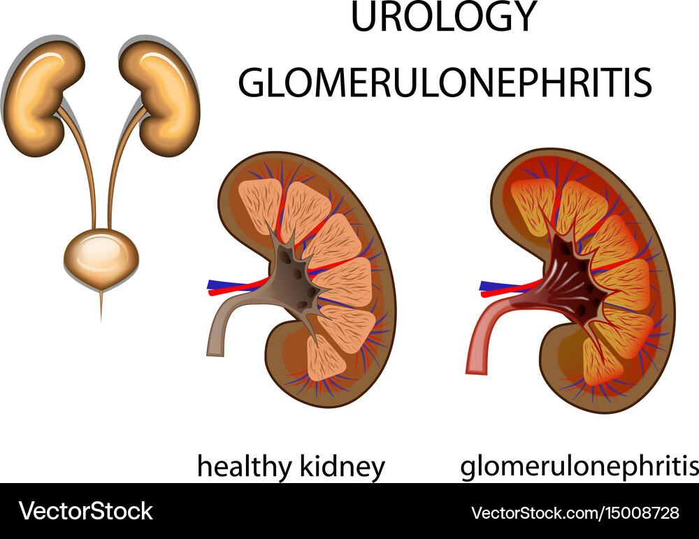 Urology kidney glomerulonephritis Royalty Free Vector Image