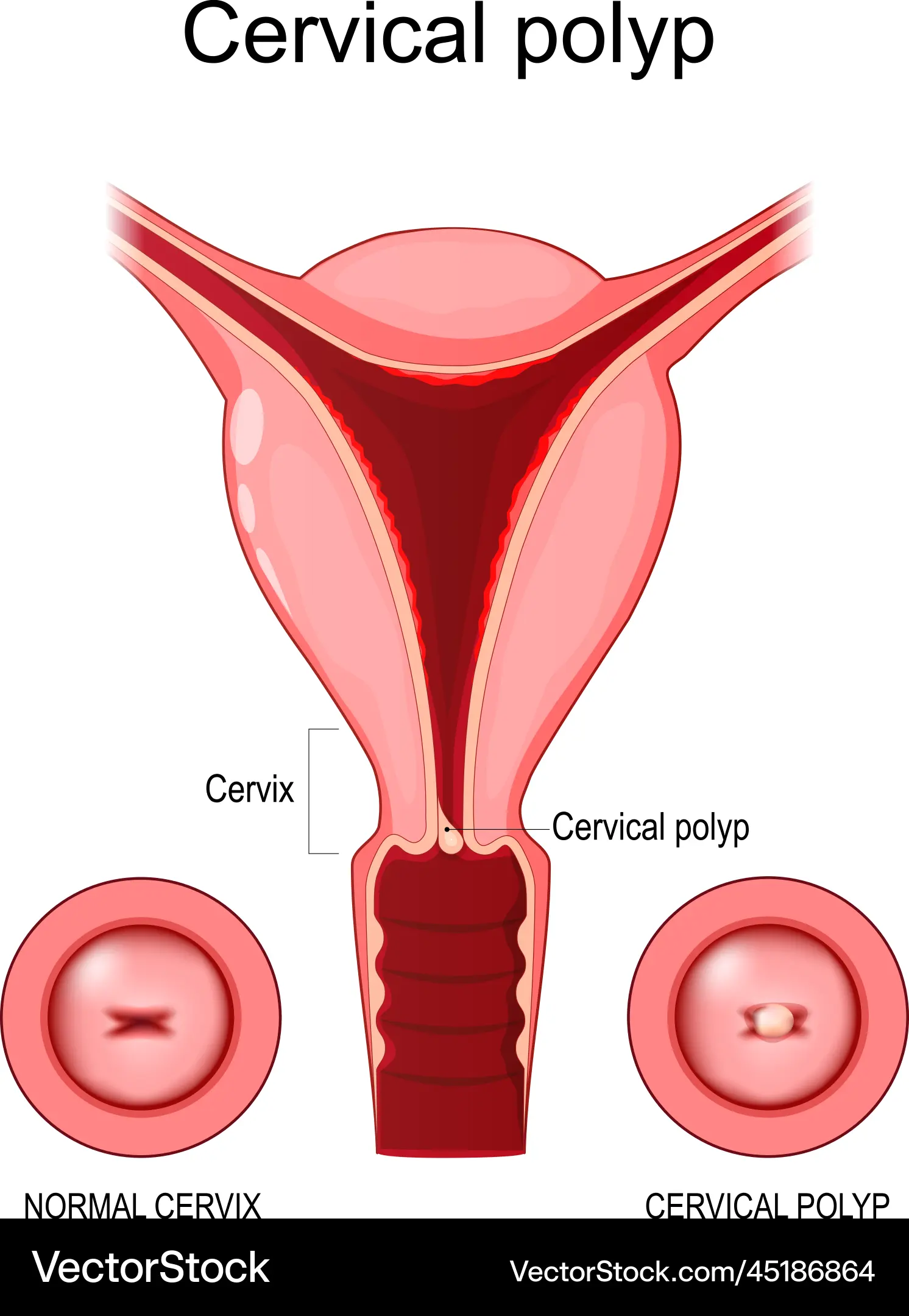 Cervical Erosion Schematic Illustration Uterus Cervix