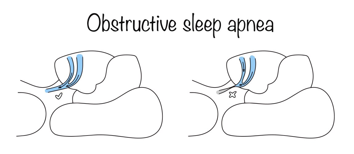Obstructive Sleep Apnea Vector Images (57)