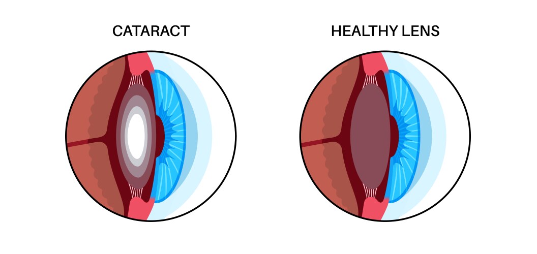 Cataract eye disease Royalty Free Vector Image