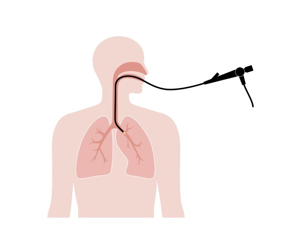 Bronchoscopy procedure concept Royalty Free Vector Image