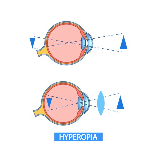 Informative chart detailing myopia hyperopia Vector Image Informative chart detailing myopia hyperopia Vector Image
