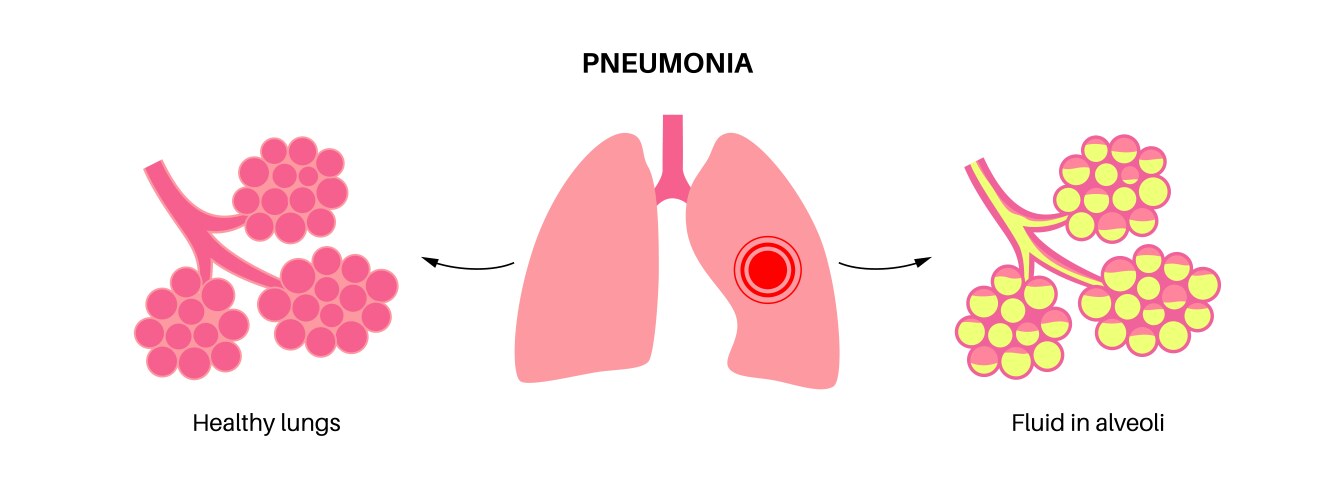 Pneumonia Royalty Free Vector Image - VectorStock