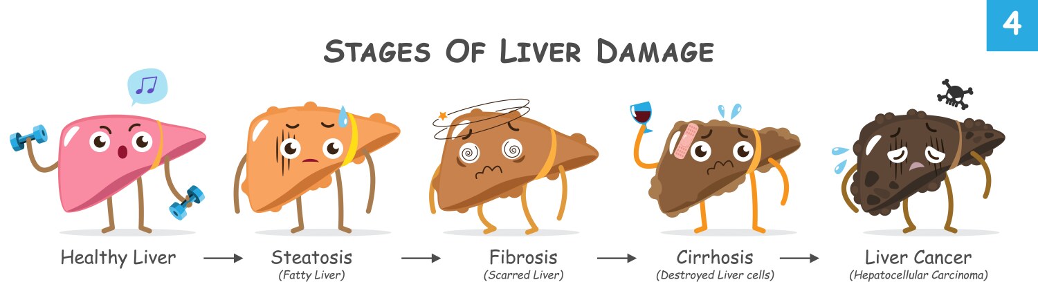 Stages of liver damage collection cute Royalty Free Vector