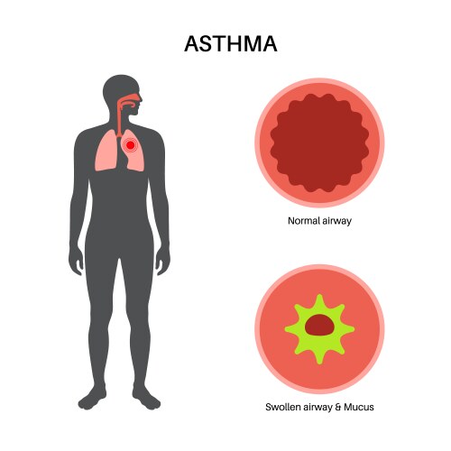 Asthma Vector Images (over 13,000)