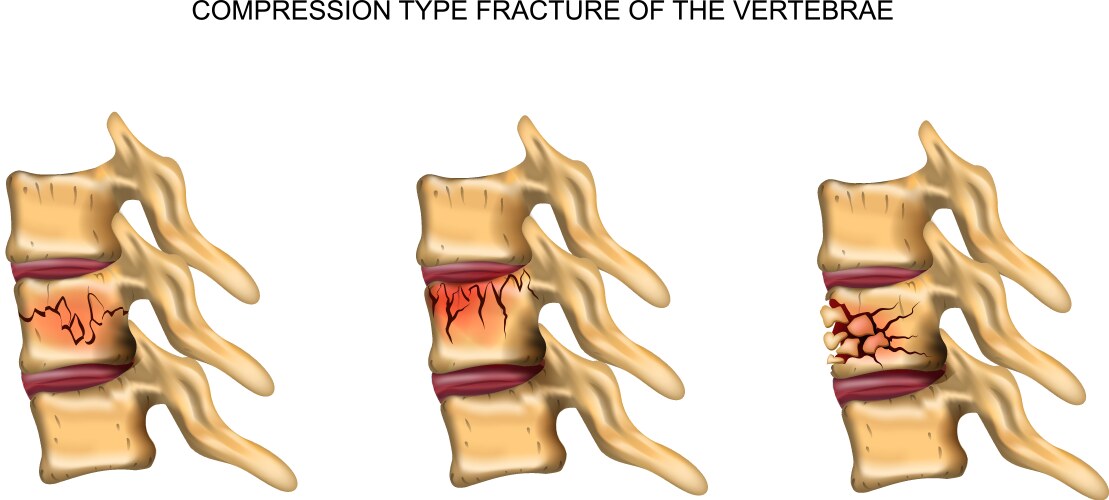 Compression Fracture Vector Images (over 200)