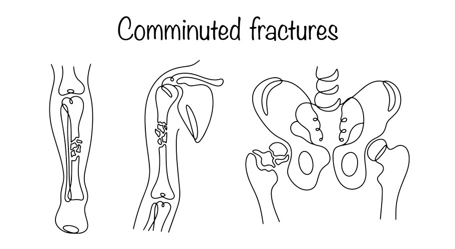 Fractures Vector Images (over 57,000)