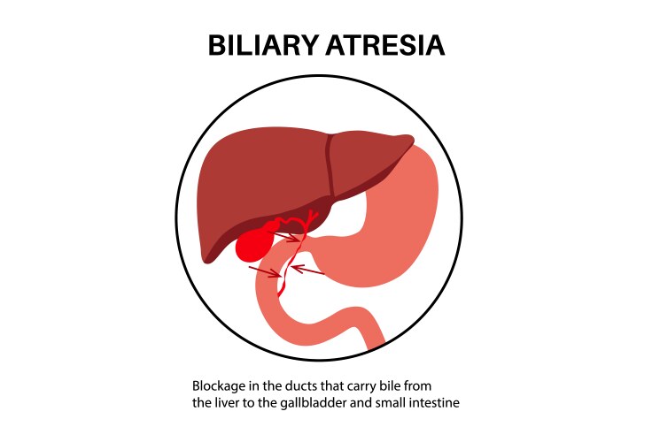 Biliary atresia disease Royalty Free Vector Image