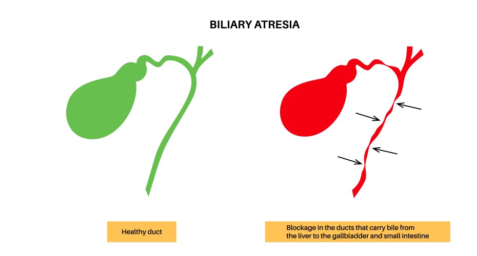 Biliary atresia disease Royalty Free Vector Image