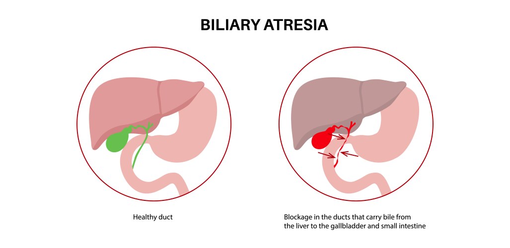 Otomycosis Royalty Free Vector Image - VectorStock