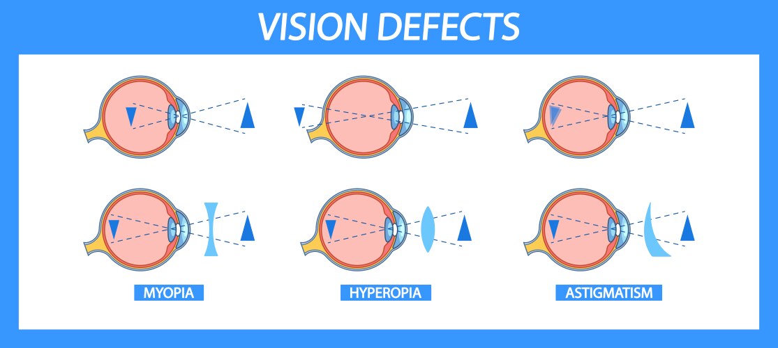 Informative infographic depicting hyperopia Vector Image