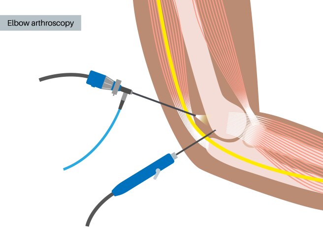 Elbow arthroscopy surgery Royalty Free Vector Image