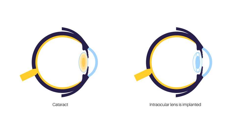 Intraocular lenses poster Royalty Free Vector Image
