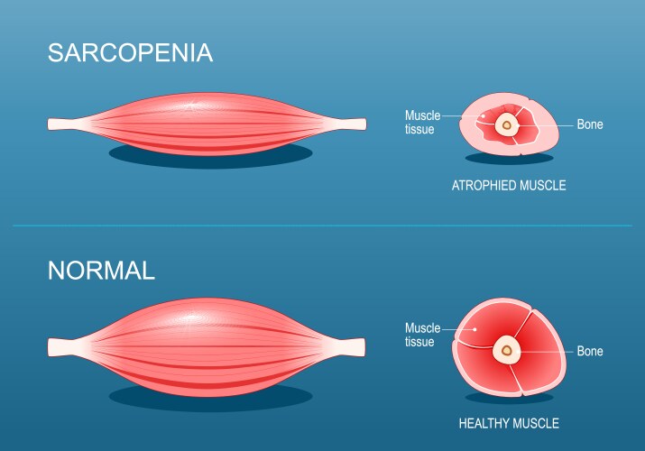 Muscle Atrophy Vector Images (50)