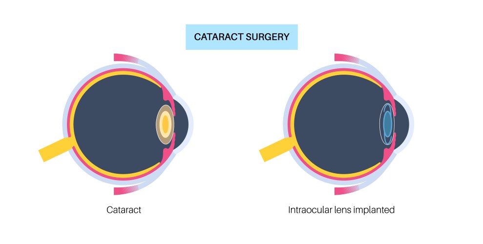 Intraocular lens poster Royalty Free Vector Image