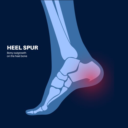 Heel spur icon Royalty Free Vector Image - VectorStock