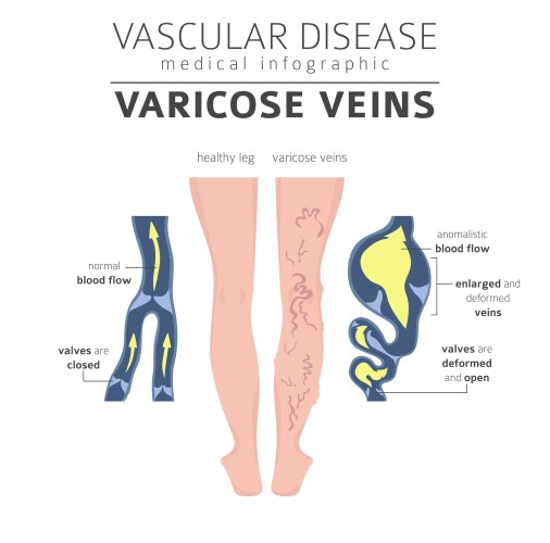 Vascular diseases vein thrombosis symptoms Vector Image