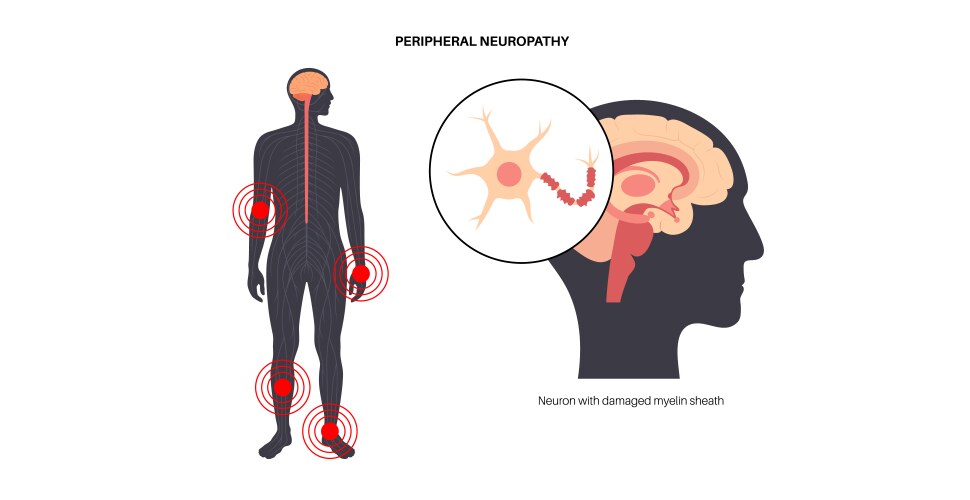 Peripheral neuropathy medical poster Royalty Free Vector