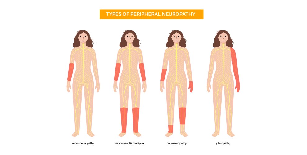 Peripheral neuropathy medical poster Royalty Free Vector