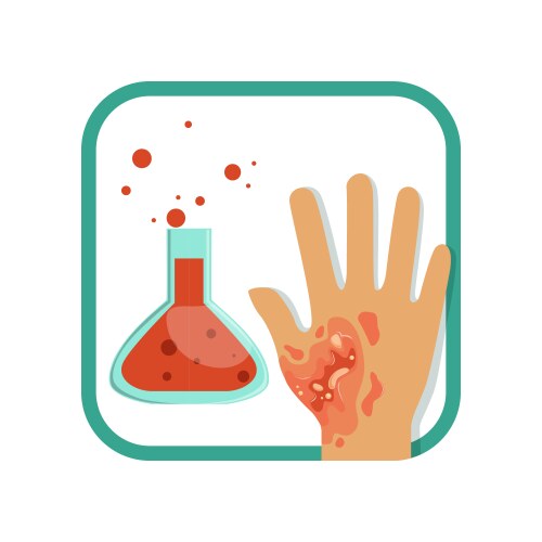 Burn Injury Treatment - Hand Care Royalty Free Vector Image